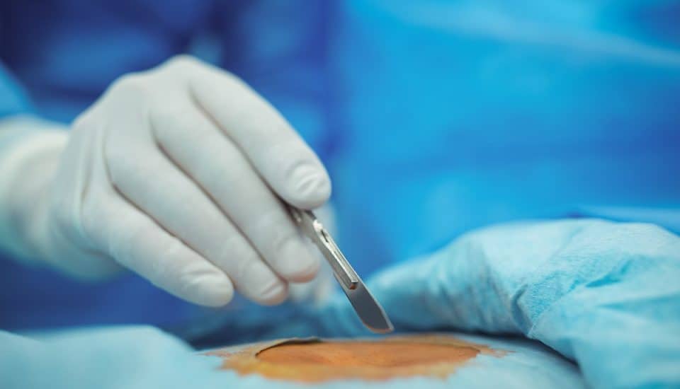 Cyst Removal London 375 TOP Surgeon In Plastic Surgery